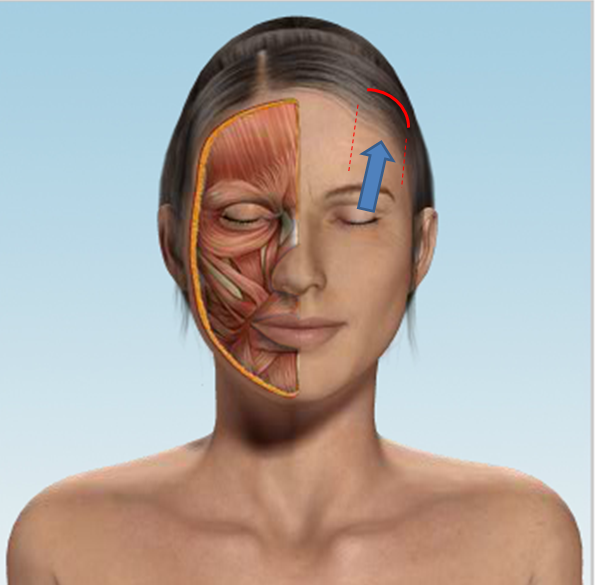 » Lifting de Frente